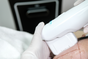 HIFU Facial Treatment: What It Is, How It Works, Its Effects, Cost, and ...